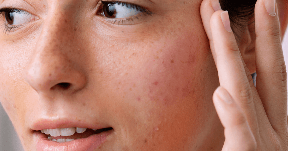 Acné : Quelles sont ses origines ? Blog - Pharmacie Lafayette